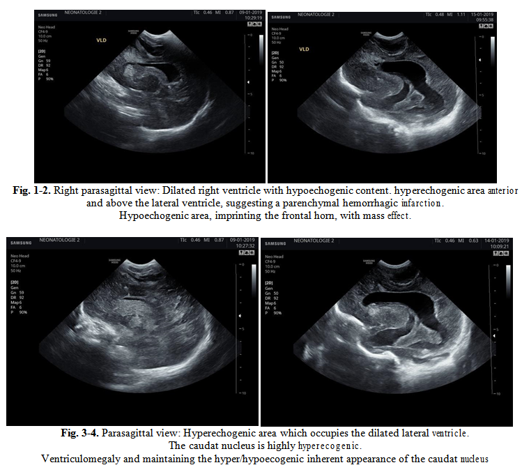 Multiple cerebral lesions associated to Perinatal Hypoxia in a Preterm ...